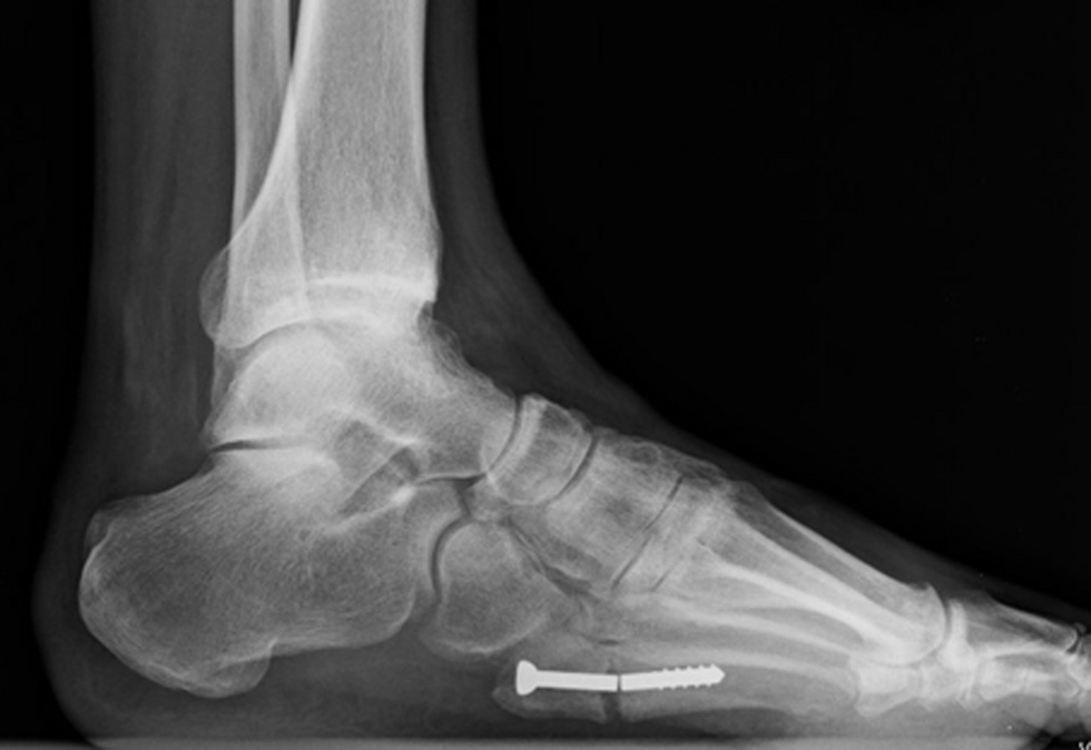 5th Metatarsal Fracture Fixation – Biomechanical Environments Laboratories
